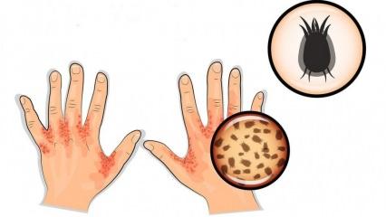 Uyuz hastalığına iyi gelen eczanedeki kremler 2024! - Güzellik Haberleri